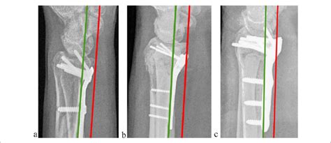 Soong Classification A Grade 0 Dorsal To Critical Line B Grade Download Scientific
