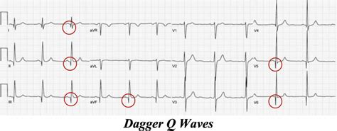 Ekg In Syncope — Maimonides Emergency Medicine Residency