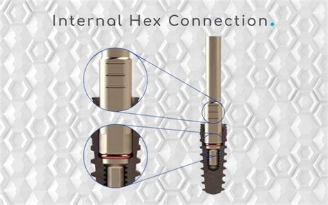 The Internal Hex Implant Connection And Its Famous Inward Migration R