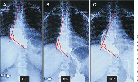 Figure 1 From Quantification Of Esophageal Angulation In Sigmoid Achalasia Are We There Yet