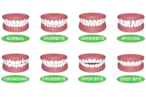 Types Of Bites Teeth At Jake Fowles Blog
