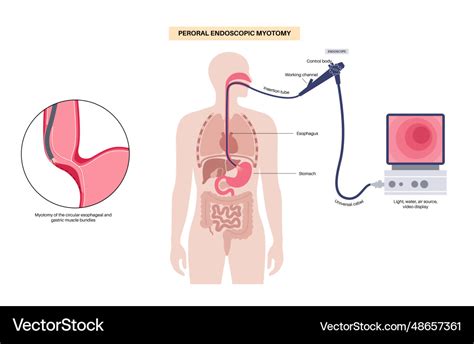 Stricture Vector Images Over 1500