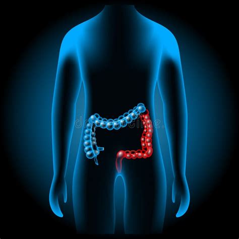 Inflammatory Bowel Disorder Stock Illustrations 180 Inflammatory
