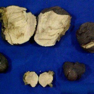 Excised Specimen Showing Multiple Skin Covered Nodules With A Yellow Download Scientific