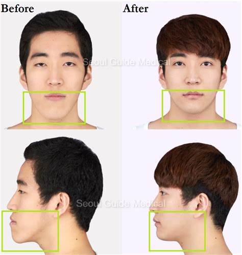 Before And After Double Jaw Surgery Seoul Guide Medical