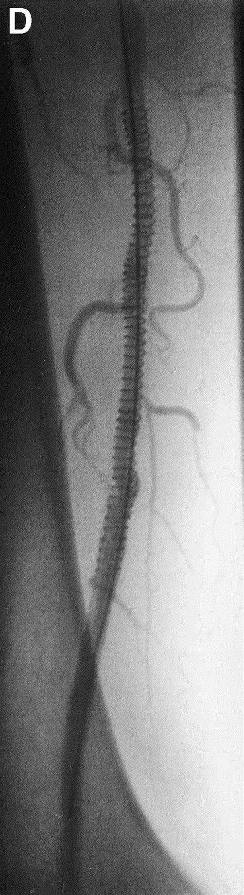 Subintimal Angioplasty For Infrainguinal Occlusive Disease Surgical