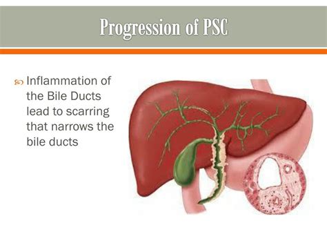 Ppt Primary Sclerosing Cholangitis Psc Powerpoint Presentation