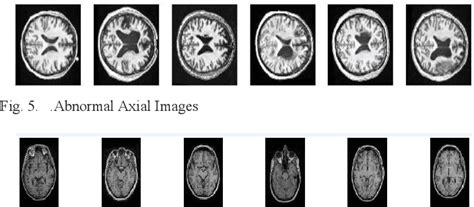 Figure 1 From Brain Stroke Detection Using Convolutional Neural Network