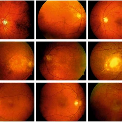Sample Images Automated Retinal Image Analysis Dataset Download