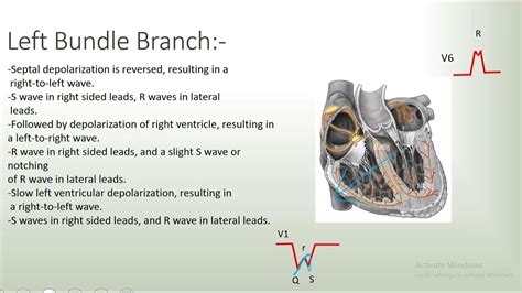Left Bundle Branch Block Ecg Tutorial Youtube