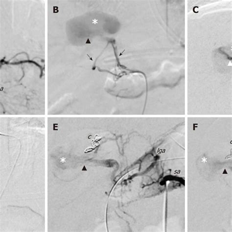 Cholangiogram A Cholangiogram From The External Biliary Drainage Download Scientific Diagram
