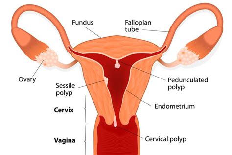 9 Common Polyp Types Health And Detox And Vitamins