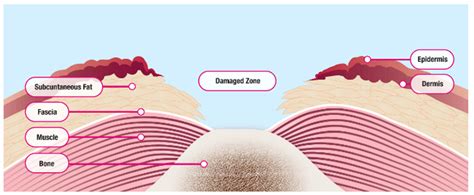 Epuap European Pressure Ulcer Advisory Panel Pressure Ulcer Classification 2019 Activheal