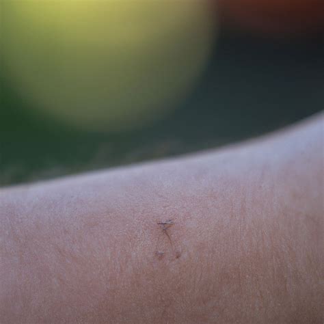 Get Relief From Mosquito Bite Rash With These Effective Remedies