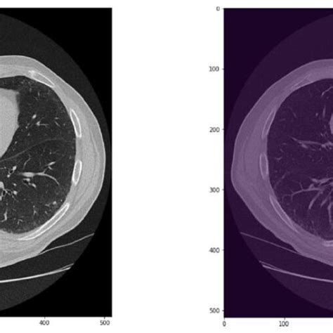 Example Of A Solid Nodule Of 6 3 Mm Inside The Red Box Wrongly Download Scientific Diagram