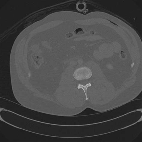 Filemulti Trauma With Traumatic Aortic Injury Diaphragmatic Rupture