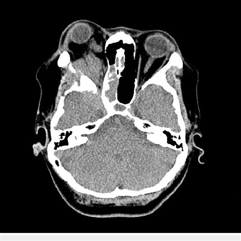 Axial Post Contrast Computed Tomography Image Demonstrates Sphenoid