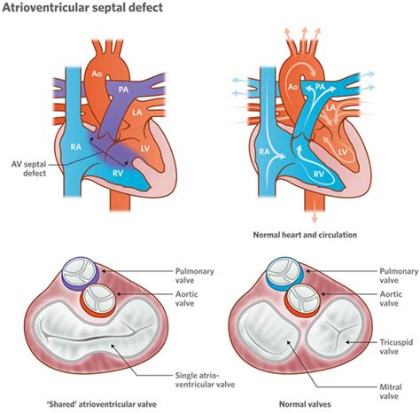 Atrioventricular Canal Defect Causes Symptoms Diagnosis Treatment