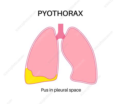 Pyothorax Illustration Stock Image F041 5875 Science Photo Library
