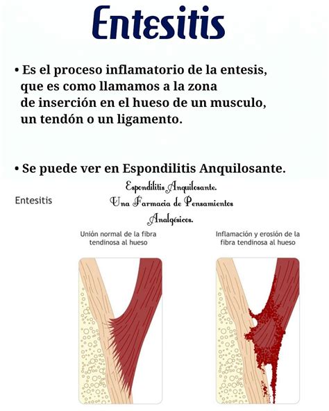 Entesitis SÍntomas Y Tratamientos Entesitis Es La Irritabilidad De Los