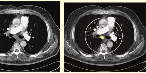 7a Cross Sectional Ct Scan Of The Thorax Showing A Station 7