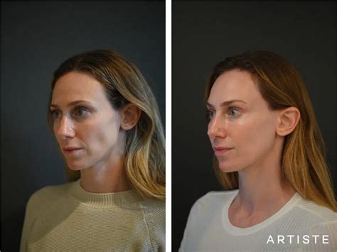 Before And After Facelift Gallery Artiste Plastic Surgery