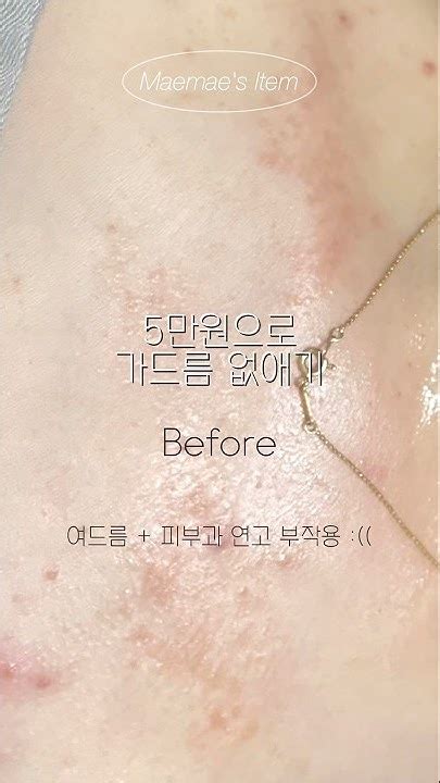 5만원으로 가드름 등드름 없애기 Youtube