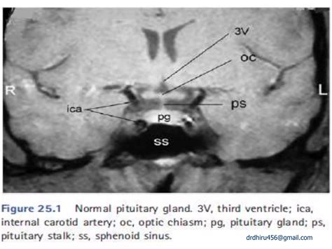 Transsphenoidal Hypophysectomy By Drdhiru456 Pptx Ear Nose And Throat Conditions Transsphenoidal Hypophysectomy By Drdhiru456 Pptx Ear Nose And Throat Conditions