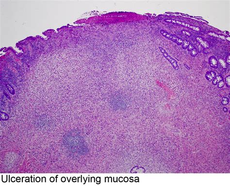 Pathology Outlines Inflammatory Fibroid Polyp Pathology Outlines Inflammatory Fibroid Polyp