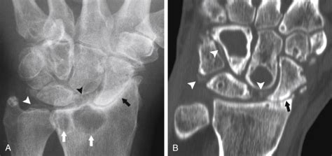 Plain Radiography And Advanced Imaging Of Calcium Pyrophosphate Dihydrate Crystal Deposition