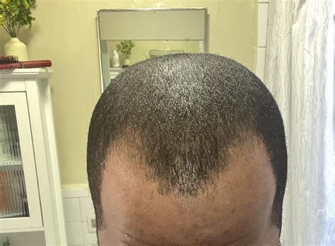 Havent Shaved In A Month Have A Chance Or Just Stay Bald R Bald