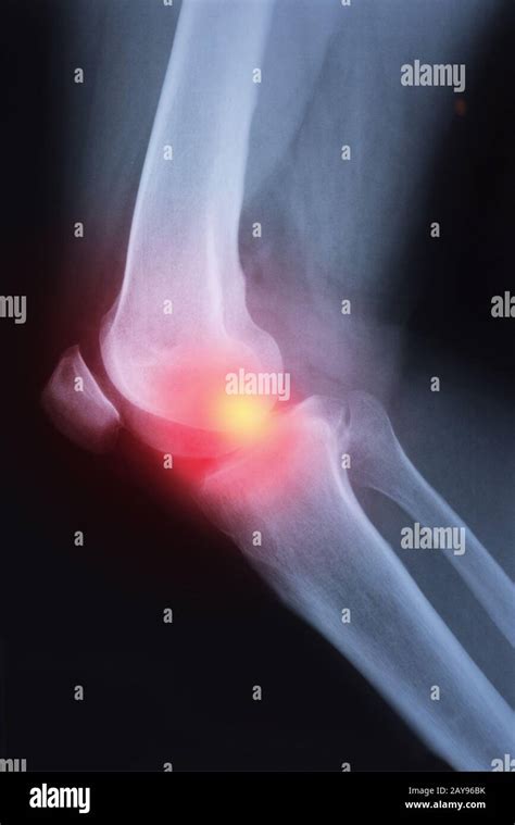 Arthritis Knee X Ray Stock Photos Arthritis Knee X Ray Stock Images