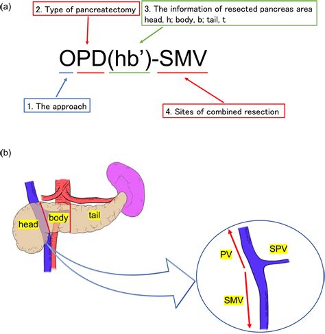 Optimizing Terminology For Pancreatectomy Introducing A New Notation System Yamane Journal