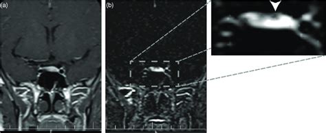 A 20 Year Old Woman With Elevated Levels Of Serum Prolactin A Early