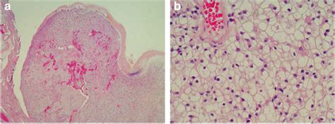 Gallbladder Specimen In Low A And High Power Field B Showing The