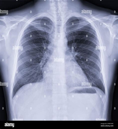 chest xray normal