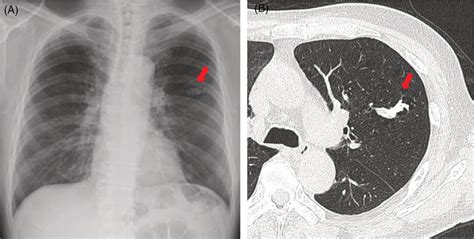 A Chest X‐ray Showing A Spindle‐shaped Calcification In The Left Download Scientific Diagram