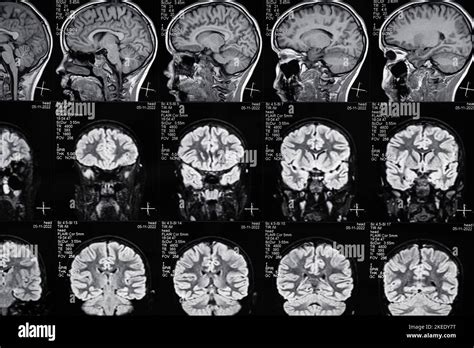 High Resolution Magnetic Resonance Image Scan Of Brain Epi Syndrome