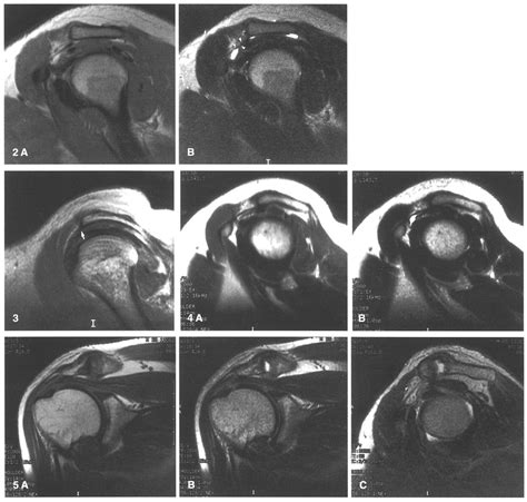 Sagittal Proton Density A And T2 Weighted B Images Showing Type I