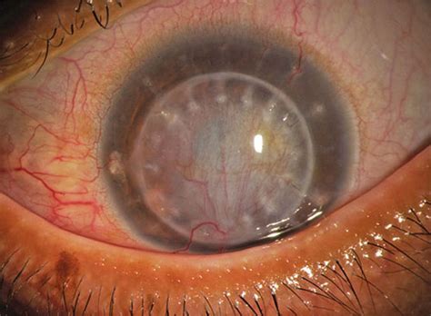 Corneal Neovascularization