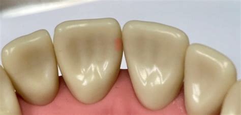 Class Iii Composite Preparation My Dental Key