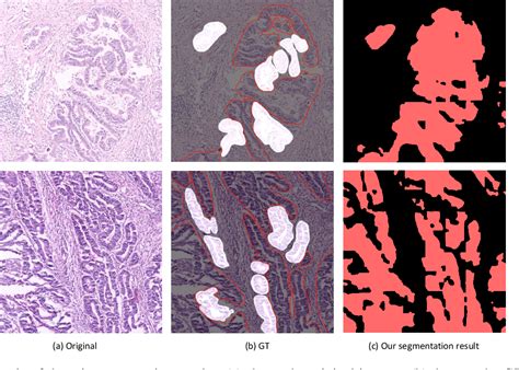 Figure 17 From Gastric Histopathology Image Segmentation Using A