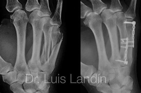 Fractura De Metacarpiano Dr Landín Dr Thione