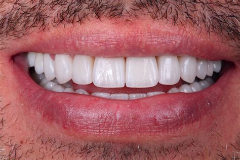 Braces In Dubai Braces Cost And Price Dental Clinic