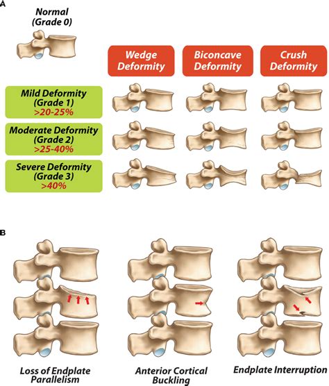 A Modified Genant Semi Quantitave Classification For Vertebral