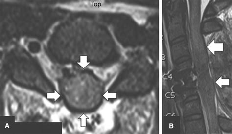 Extent Of Spinal Cord Decompression In Motor Complete American Spinal