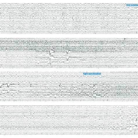 Ictal Eeg Pattern In Patient 2 At The Age Of 4 Months Seizure Started