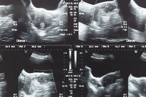 What To Know About Uterine Fibroid Complications Biwei必威 Betway必威官网注册 必威体育 西汉姆联