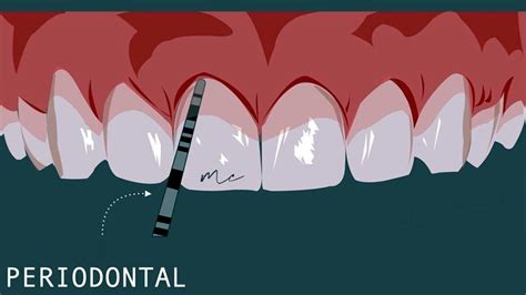Periodontal Disease Grade 3 Signs Or Symptoms And Treatment