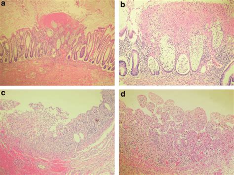 A Pseudomembranous Colitis B Pseudomembranous Appendicitis C Download Scientific